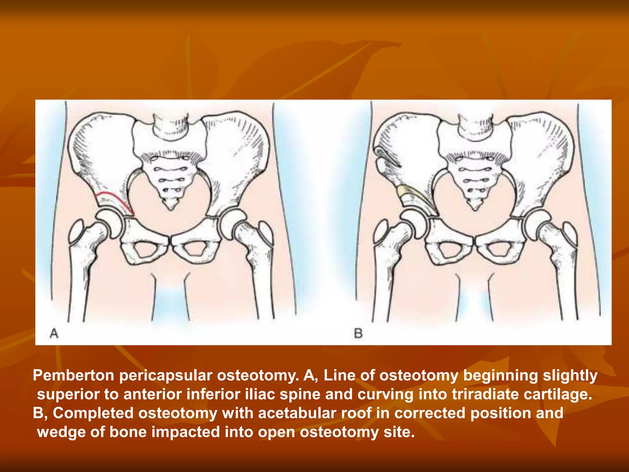 Osteotomies around the hip | PPT