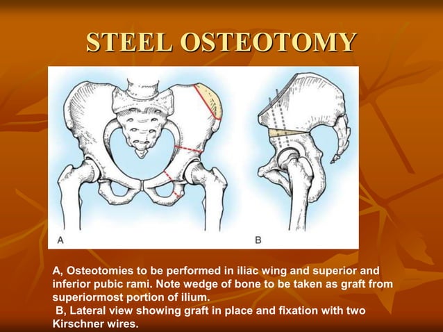 Osteotomies around the hip | PPT