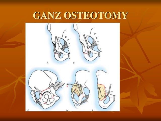 Osteotomies around the hip