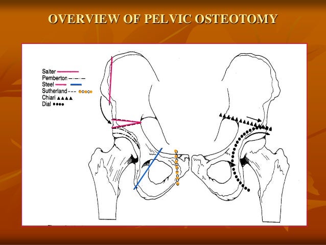 Osteotomies around the hip