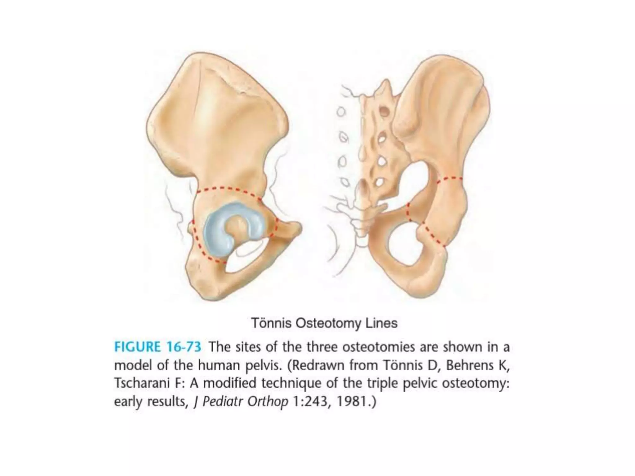 Osteotomies around the hip | PPTX