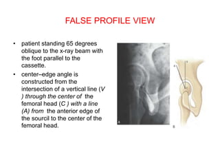 Osteotomies around the hip | PPTX