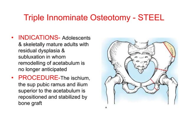 Osteotomies around the hip | PPTX