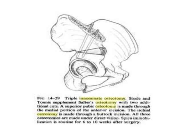 Osteotomies around the hip | PPTX