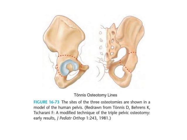 Osteotomies around the hip | PPTX