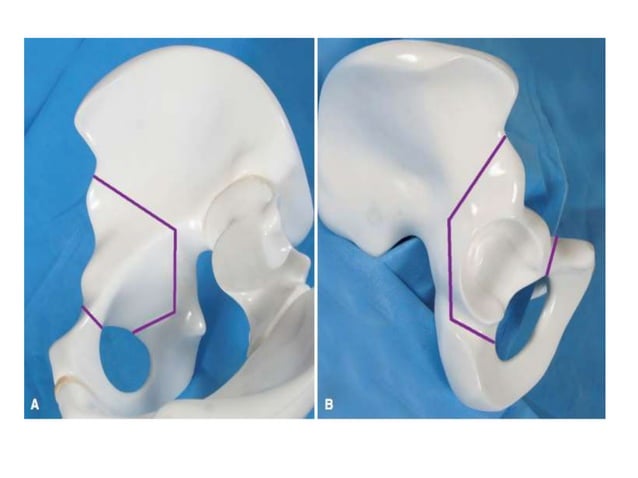Osteotomies around the hip | PPTX