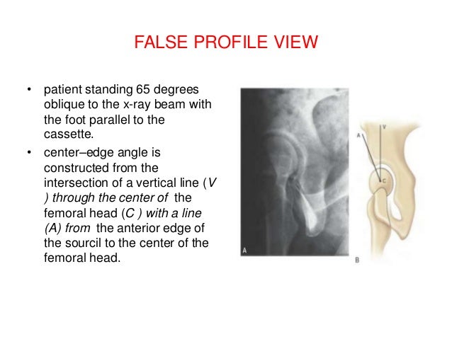 Osteotomies around the hip