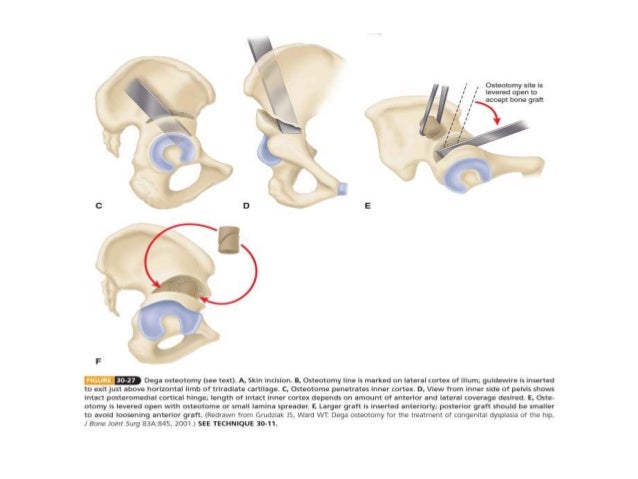 Osteotomies around the hip