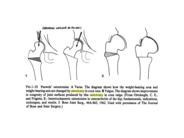 Osteotomies around the hip