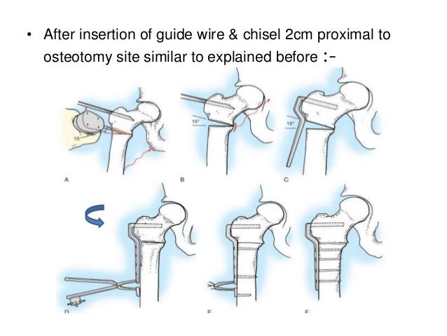 Osteotomies around the hip