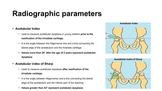 OSTEOTOMIES AROUND THE HIP (Acetabular and Proximal Femur).pptx