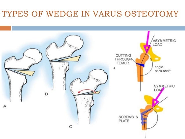 Osteotomies around the hip -sid