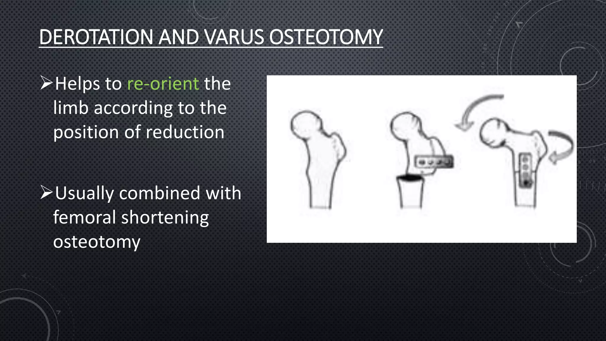 Osteotomies around the hip in DDH | PPTX