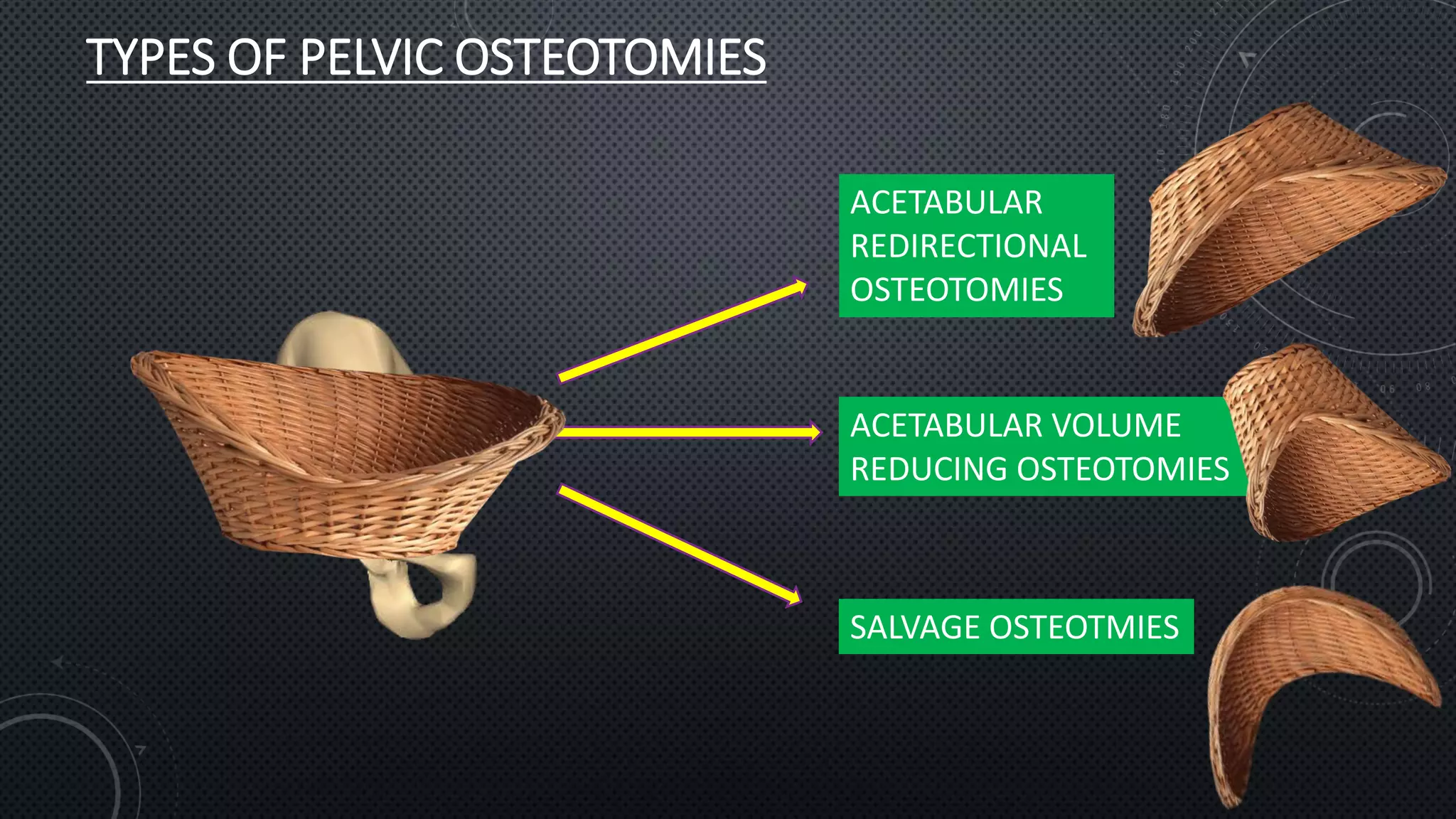 Osteotomies around the hip in DDH | PPTX