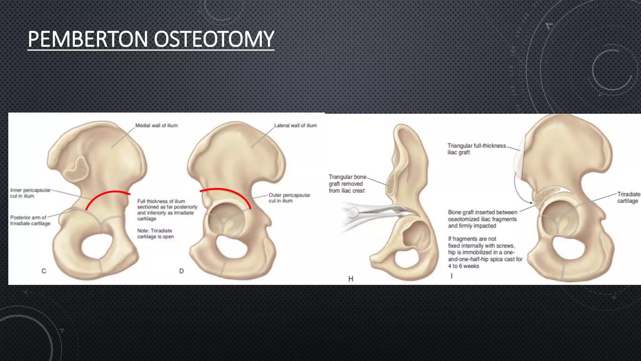 Osteotomies around the hip in DDH | PPTX