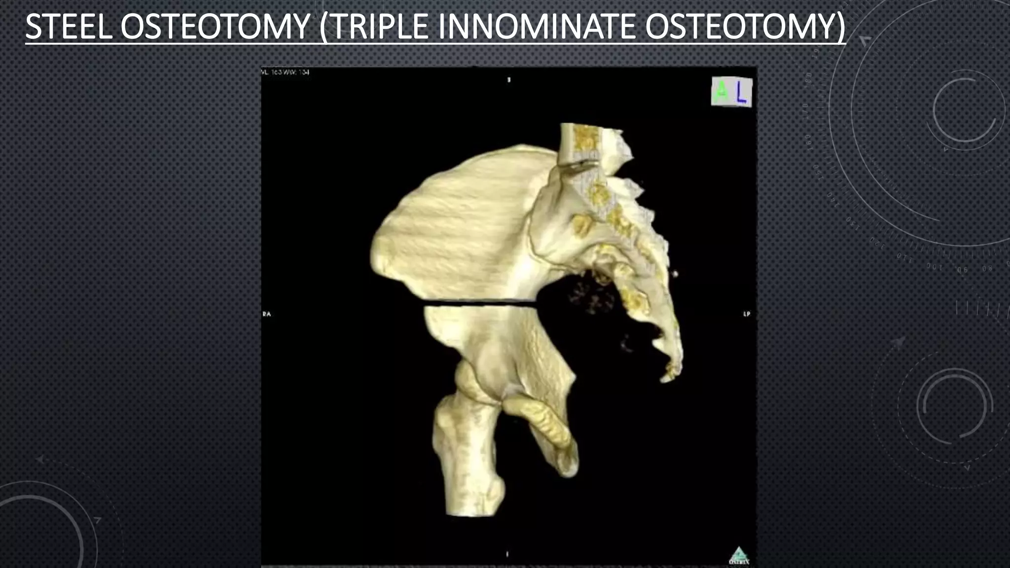 Osteotomies around the hip in DDH | PPTX