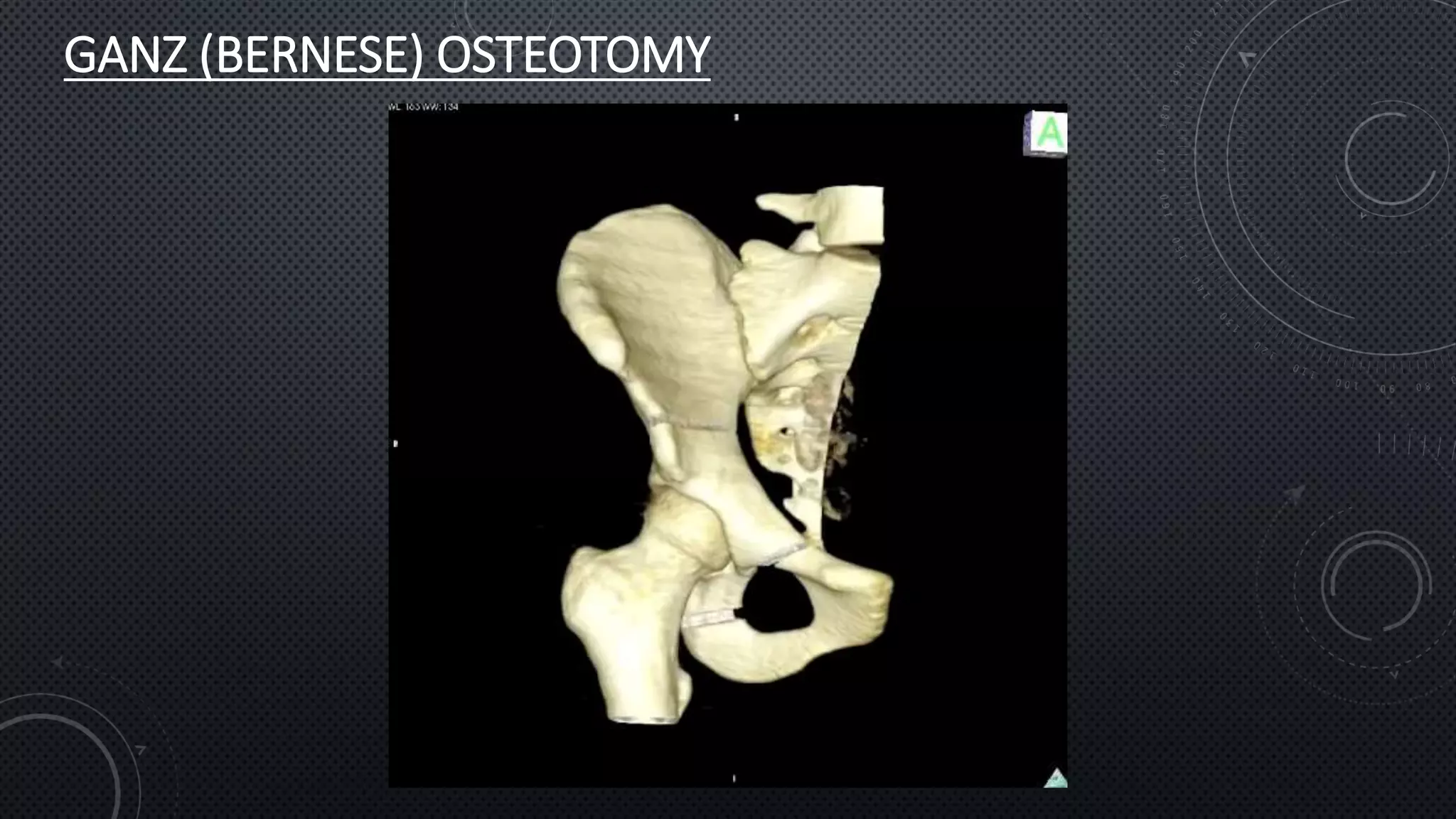 Osteotomies around the hip in DDH | PPTX