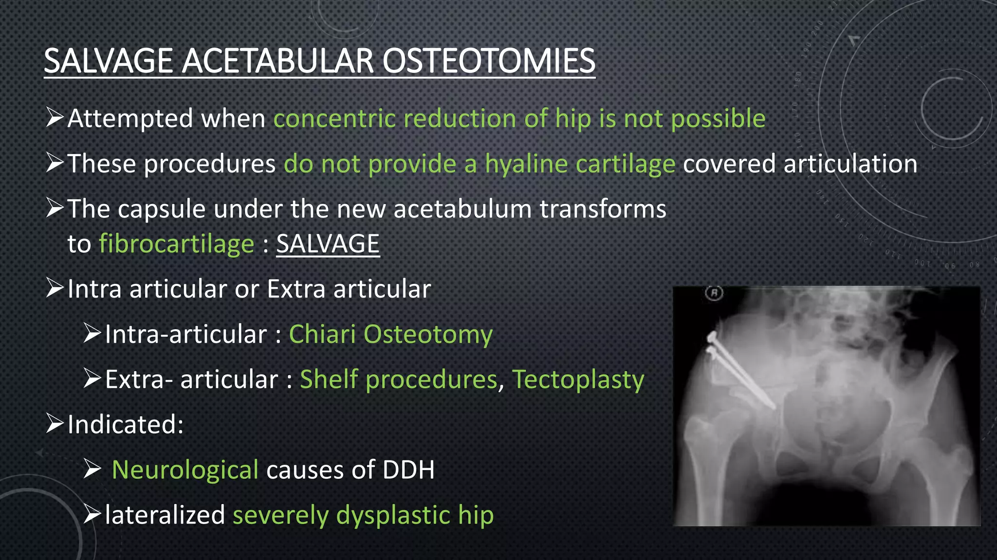 Osteotomies around the hip in DDH | PPTX