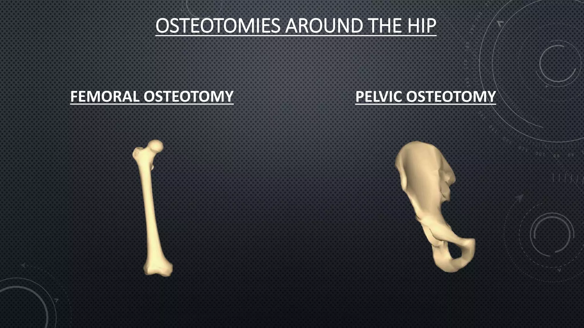 Osteotomies around the hip in DDH | PPTX