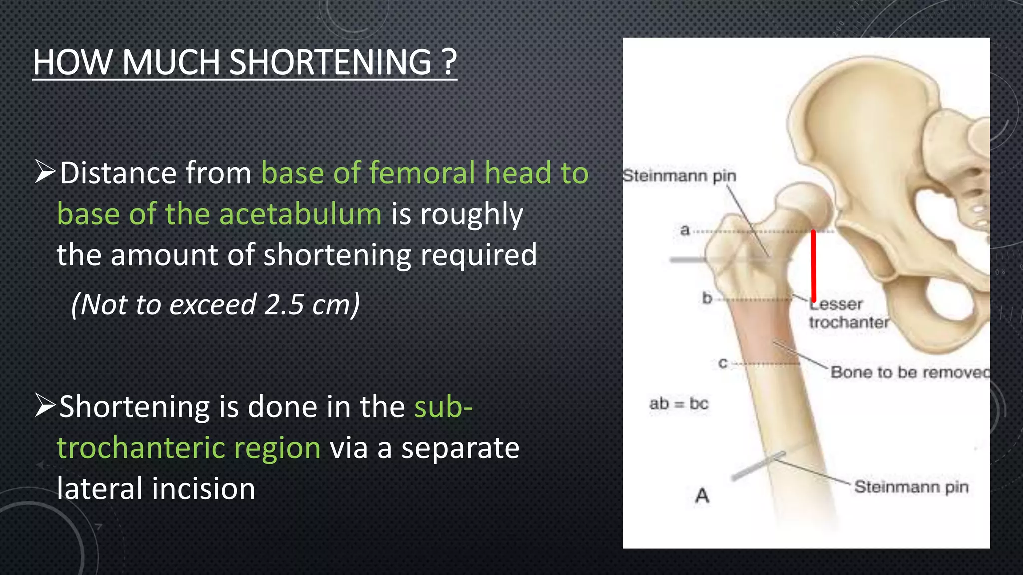 Osteotomies around the hip in DDH | PPTX