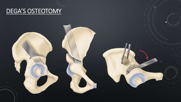 Osteotomies around the hip in DDH | PPTX | Death, Injury, or Military ...