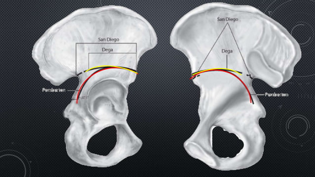 Osteotomies around the hip in DDH | PPTX | Death, Injury, or Military ...