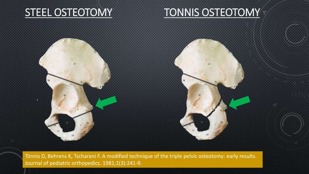 Osteotomies around the hip in DDH | PPTX | Death, Injury, or Military ...