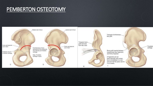 Osteotomies around the hip in DDH