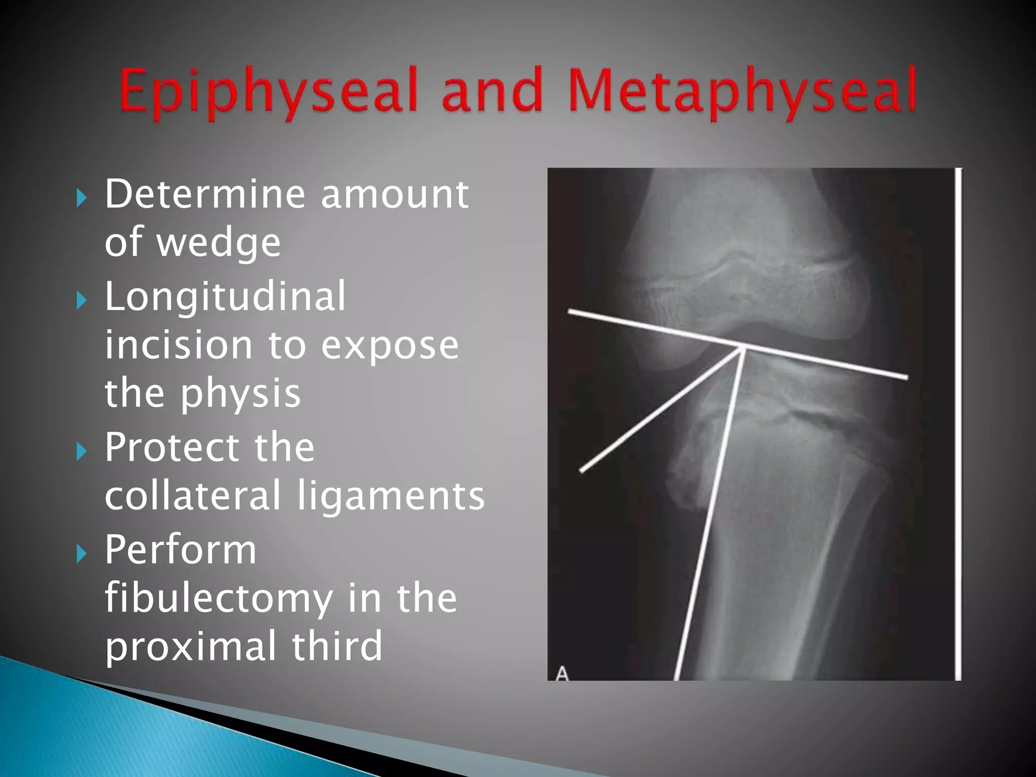 Osteotomies for blounts | PPTX