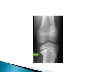 Osteotomies for blounts | PPTX