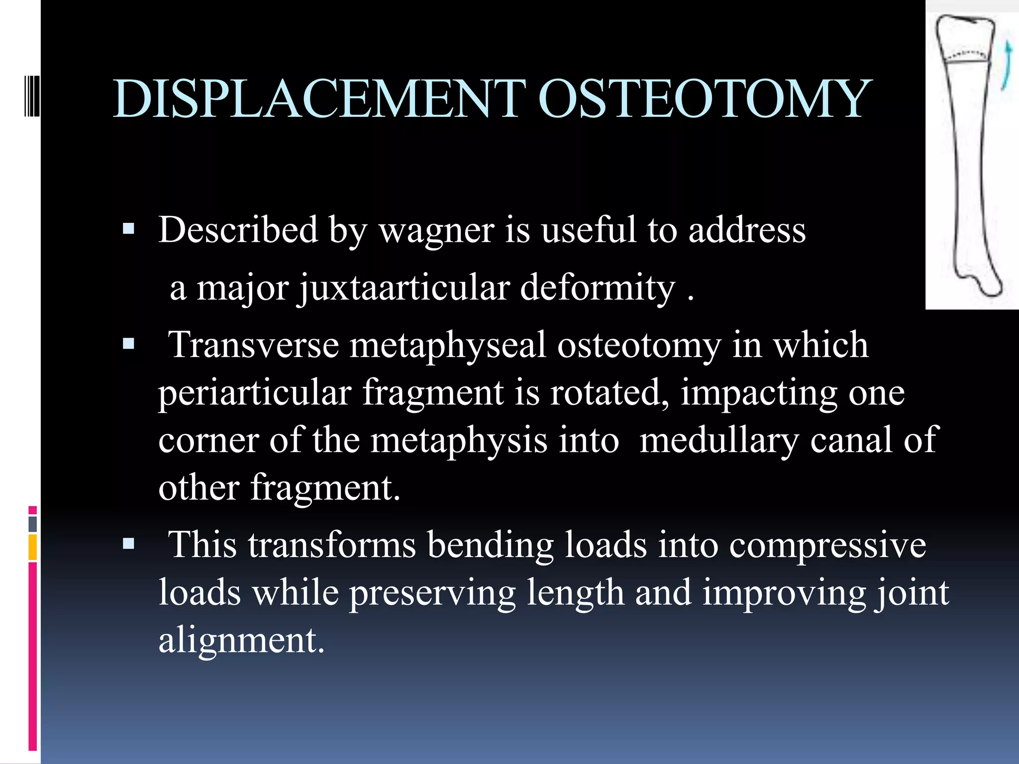 Osteotomy | PPTX