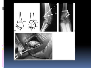 Osteotomy | PPTX