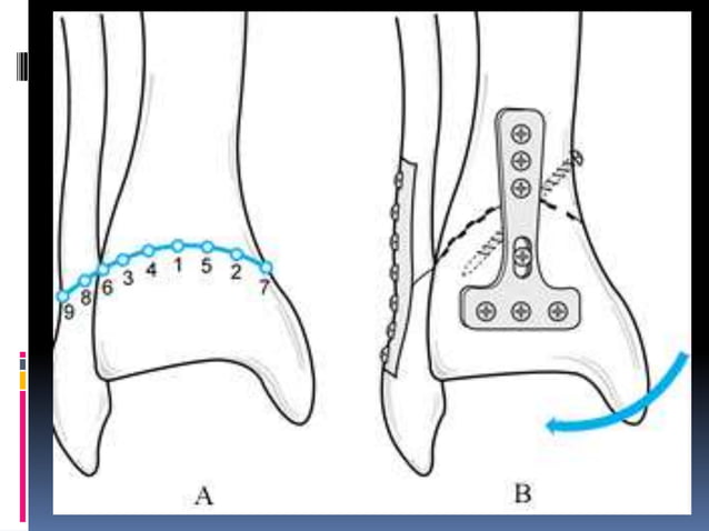 Osteotomy | PPTX | Death, Injury, or Military Conflict | Sensitive Topics