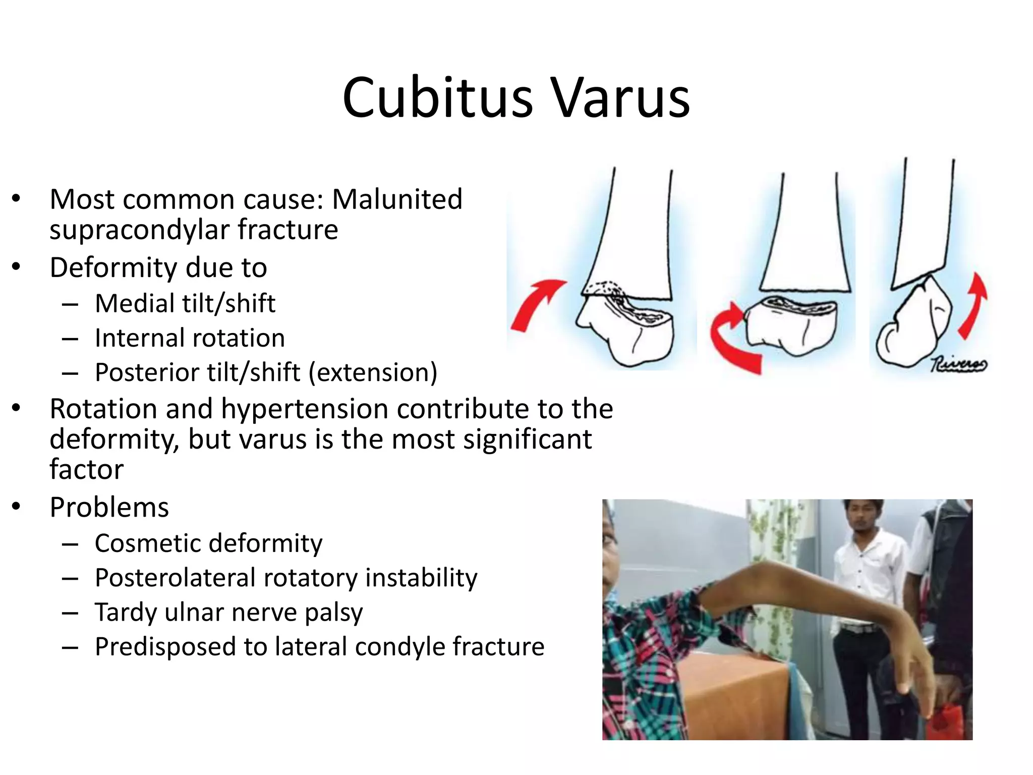 Osteotomy around elbow | PPTX