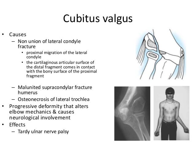 Varus Vs Valgus Fracture