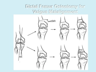 Osteotomy around knee dr shankar jangid (1) | PDF