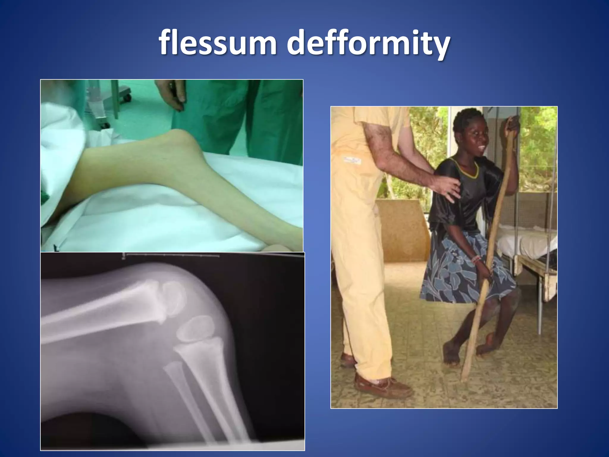 Osteotomy around the knee in children.when and why? | PPTX