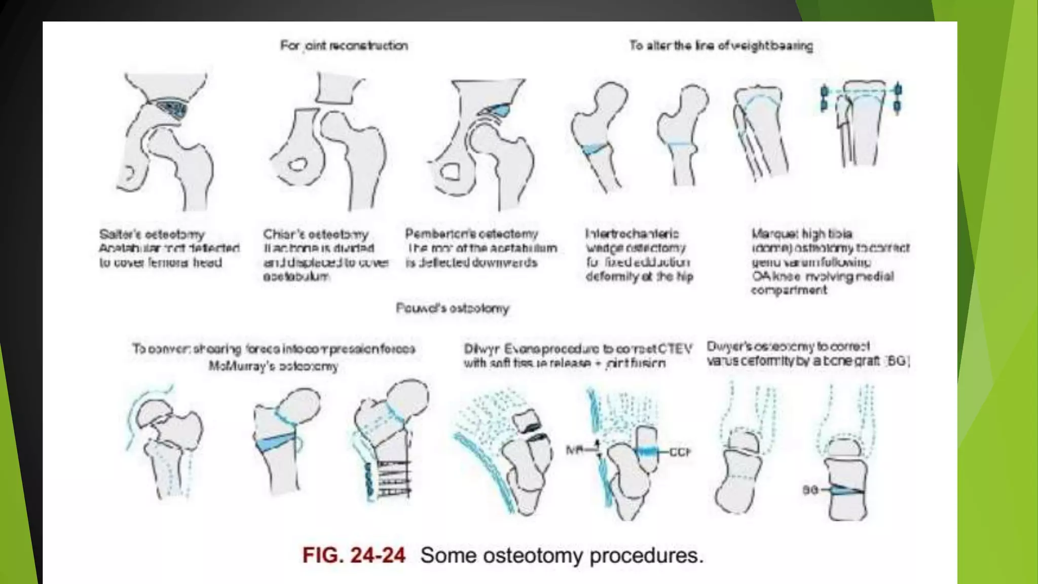 Osteotomy and physiotherapy | PPTX
