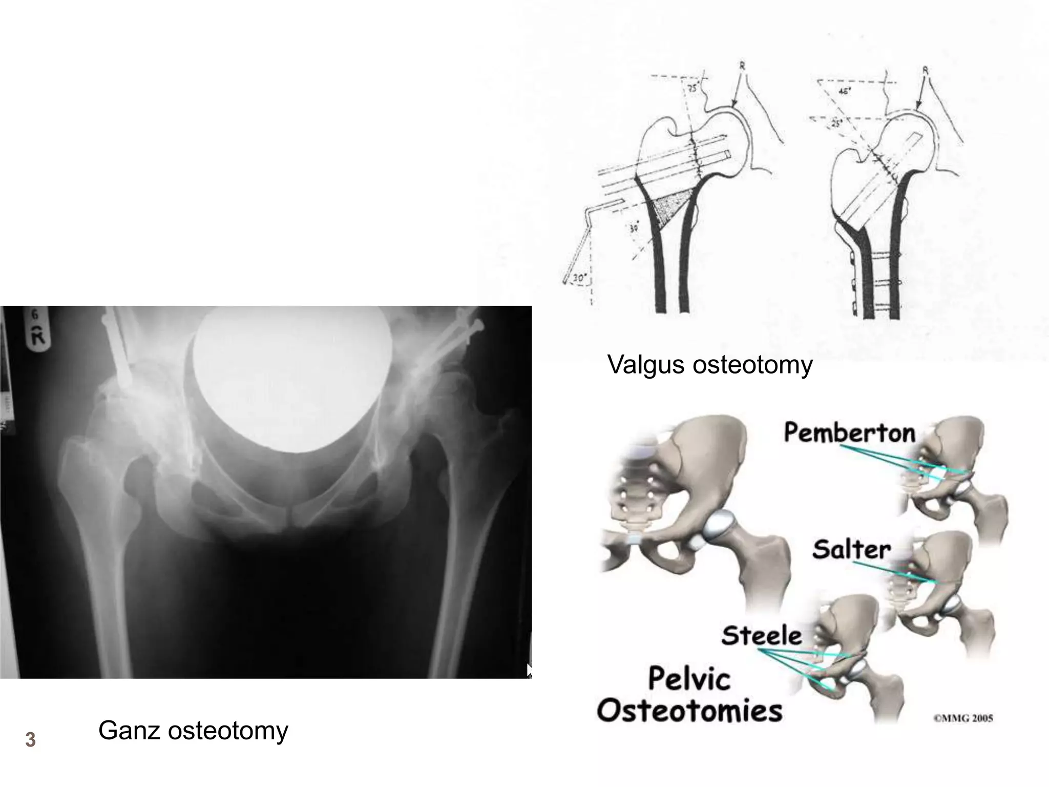 Ostetomies around hip by hemant mamc | PPTX