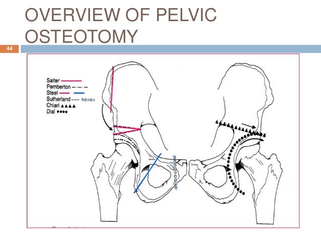 Ostetomies around hip by hemant mamc