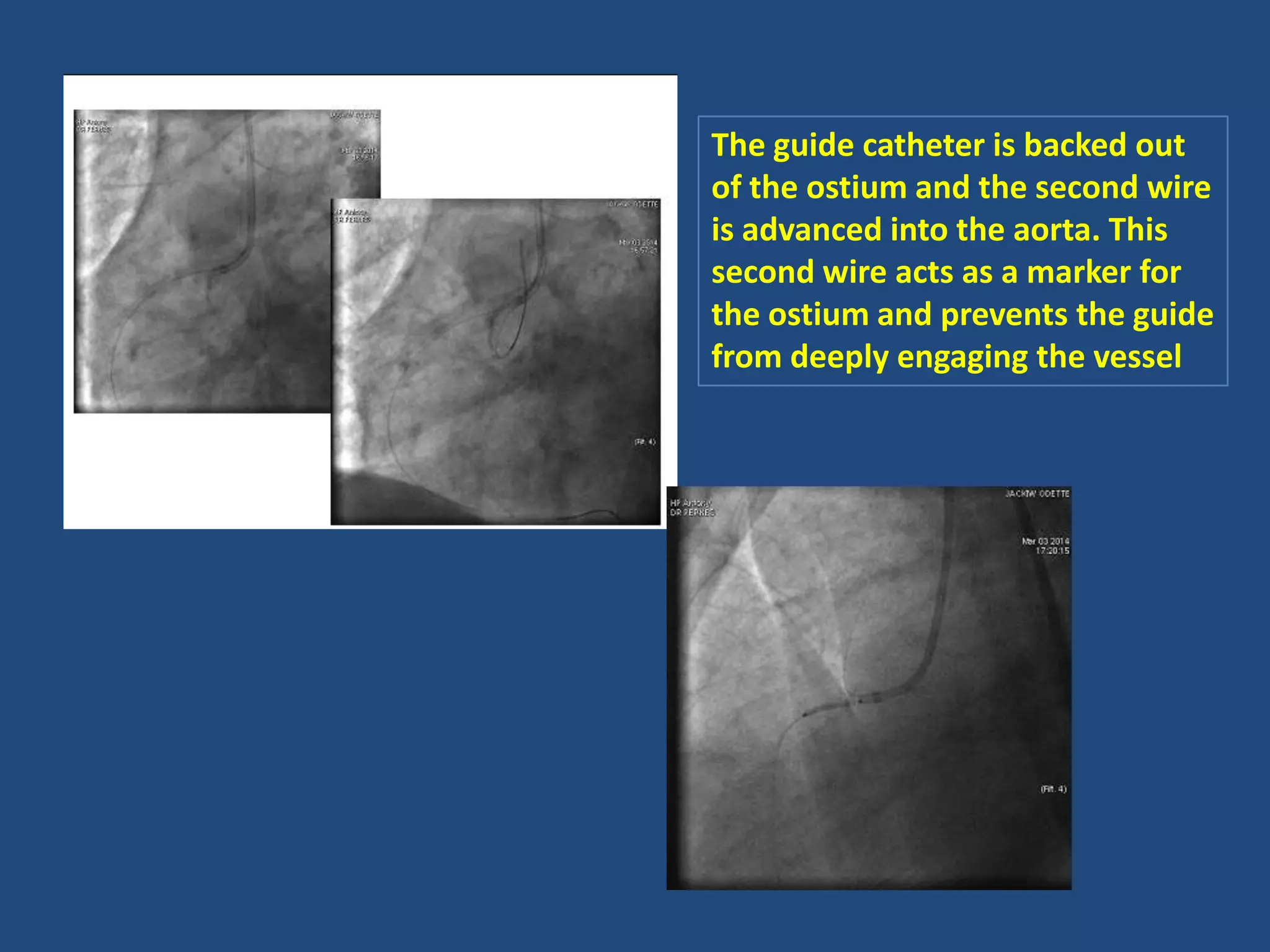 Coronary Ostial stenting techniques:Current status | PPTX