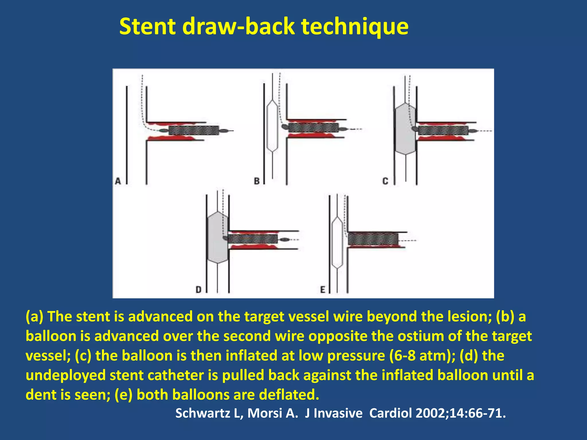 Coronary Ostial stenting techniques:Current status | PPTX