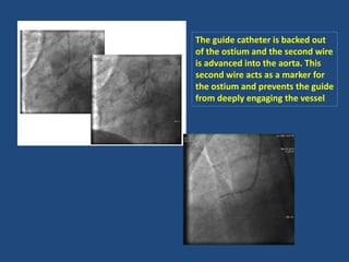Coronary Ostial stenting techniques:Current status | PPTX