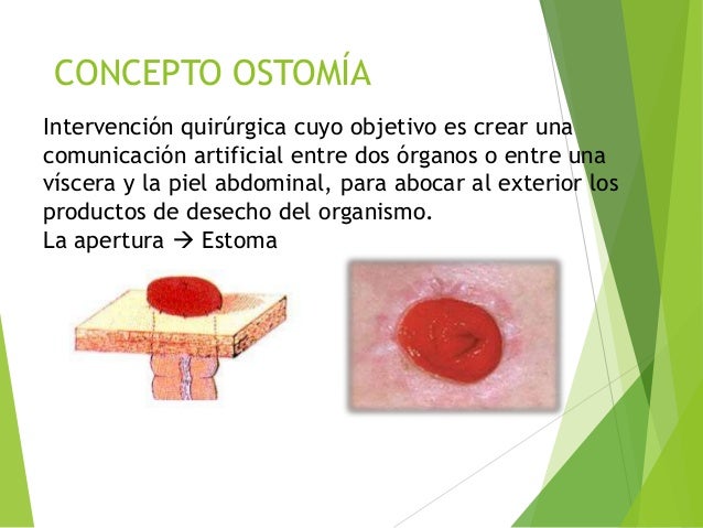 Ostomia completo