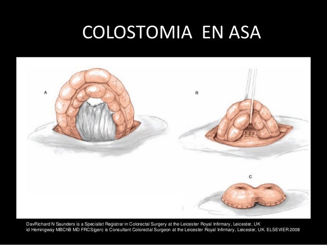 Ostomias