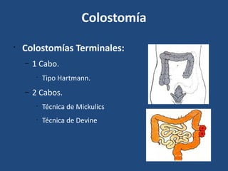 Ostomias de drenaje Ileostomías y Colostomías (8).pdf