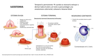 OSTOMIAS abdominales.pptx