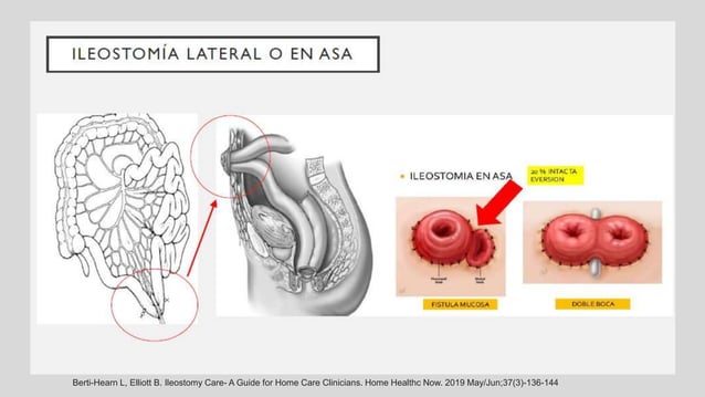 clasificacion de ostomias ficha .pptx