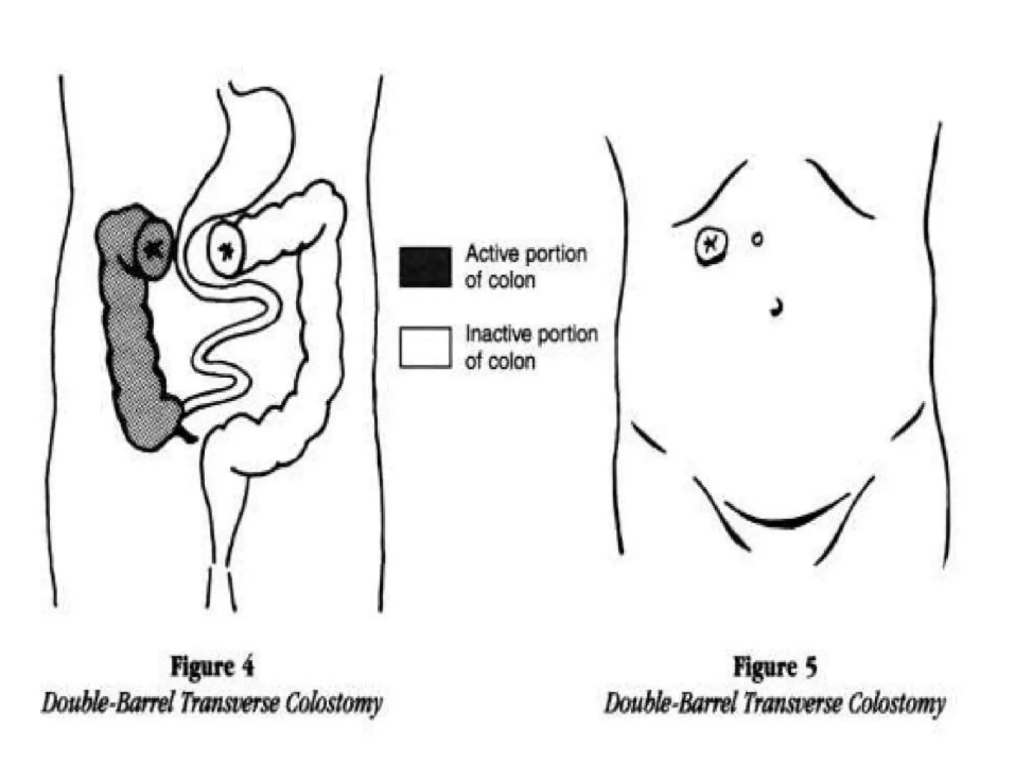 ostomy-care.pptx