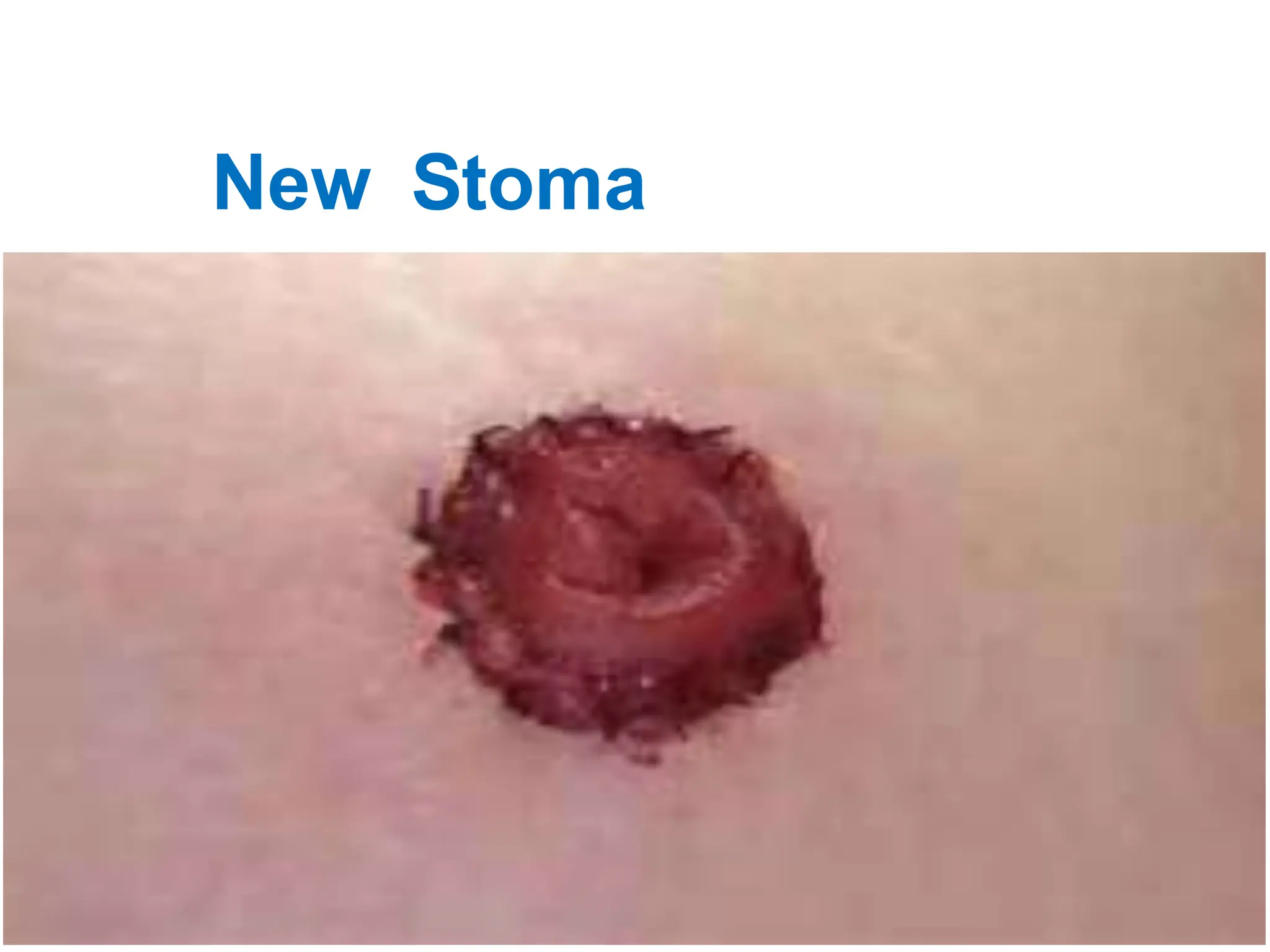 ostomy-care.pptx